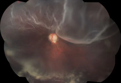 Retinal Tear and Detachment — Retina Macula Institute