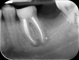 Non-surgical retreatment of lower first molar | Norfolk Endodontics ...