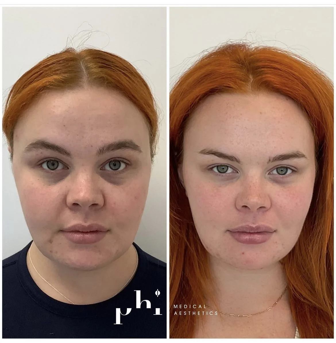 Facial Balancing — PHI Medical Aesthetics