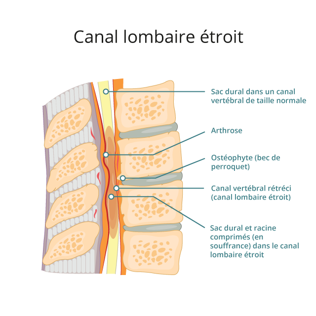 Artificiel Les épines Postimpressionnisme compression sac dural ...