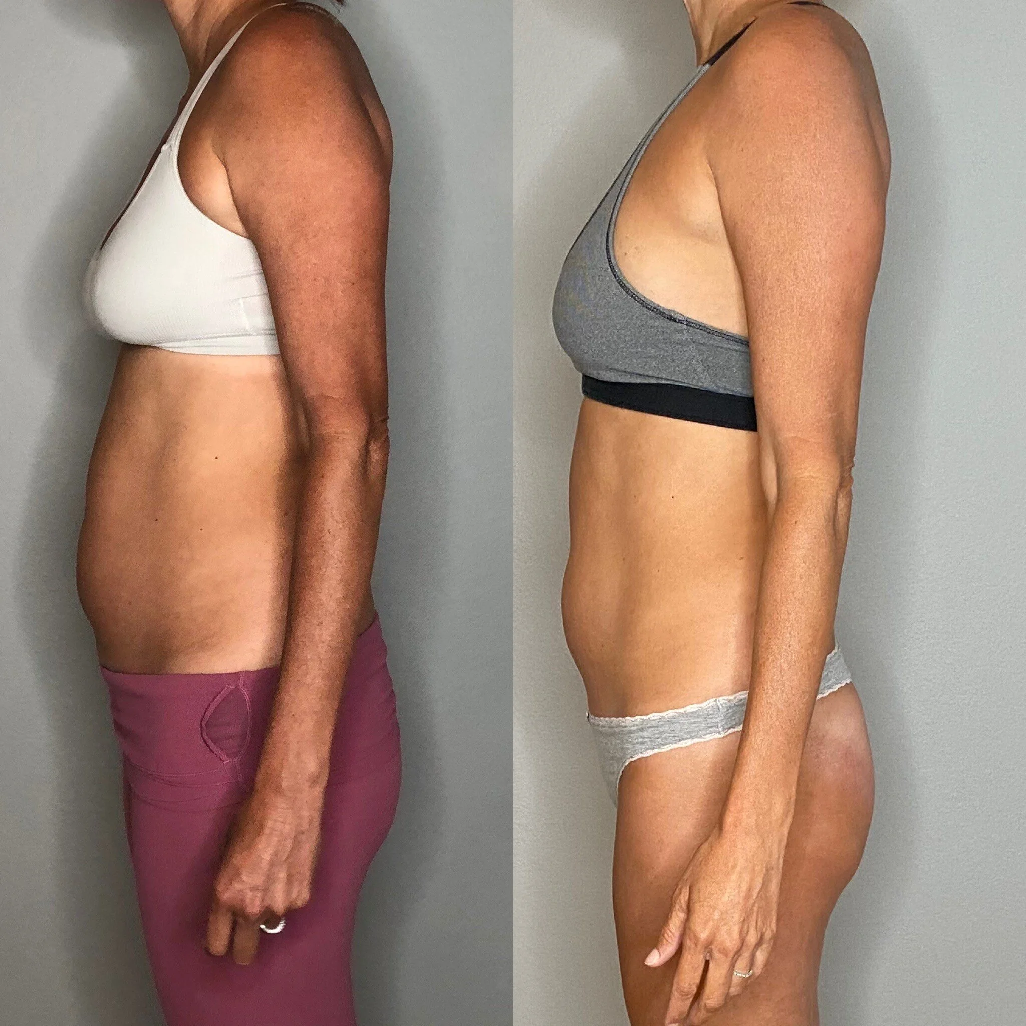 Radio Frequency Skin Tightening Meridiem Aesthetics Meridiem Aesthetics Radio Frequency Skin Tightening Meridiem Aesthetics Meridiem Aesthetics