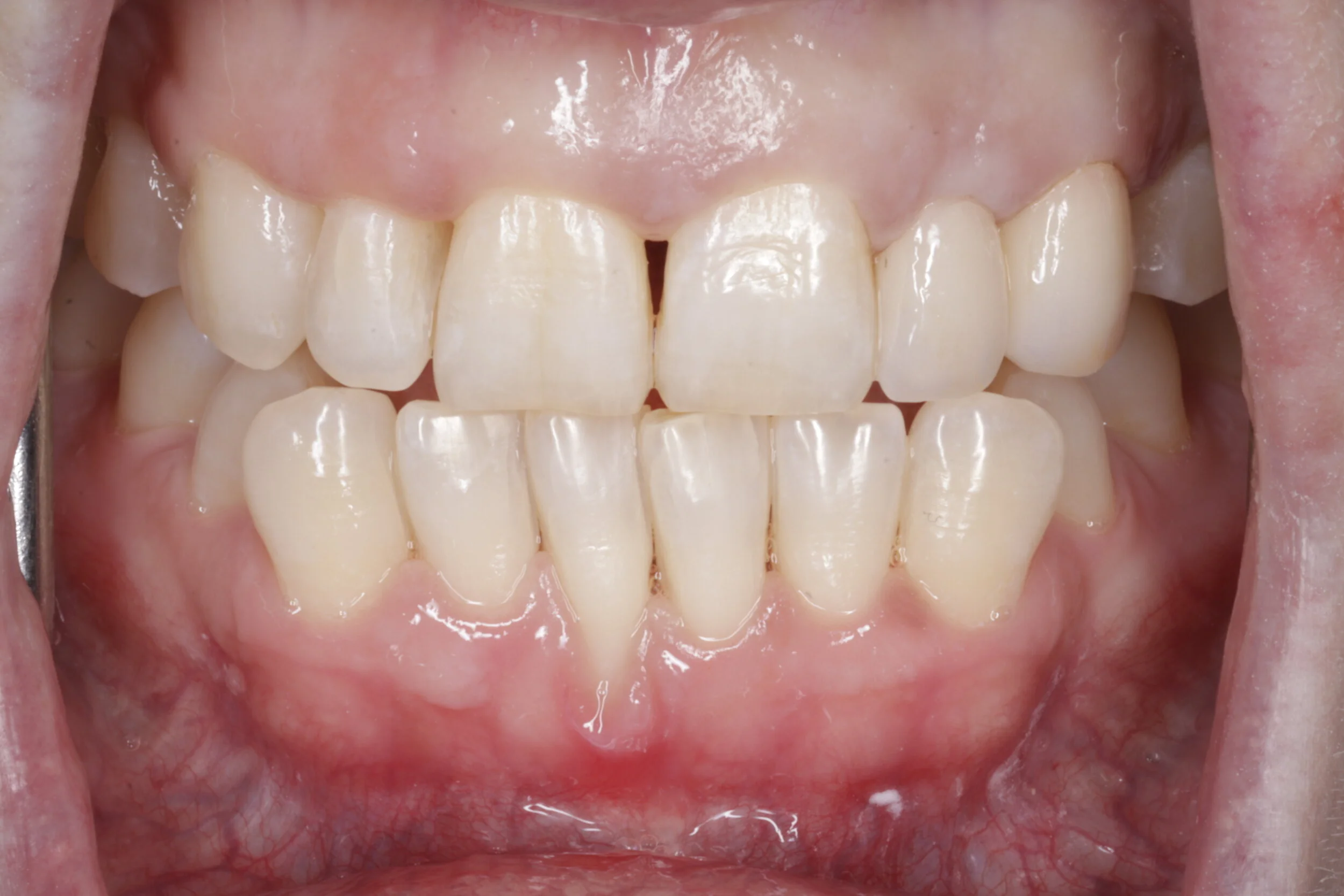 Deep Scaling – Hygienist Dentist — Clean Teeth Dental