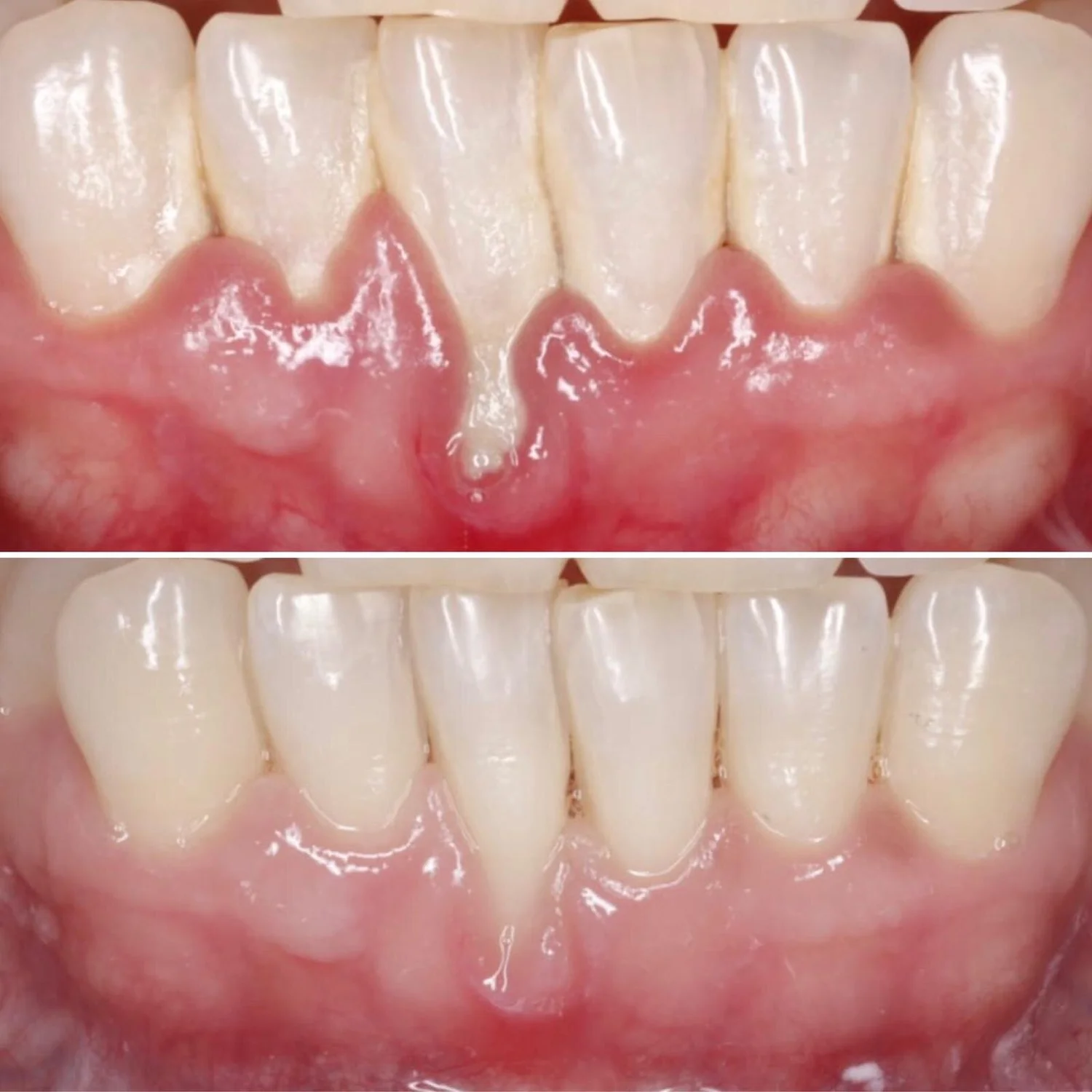 Gum Recession & Graft Surgery, NZ — Clean Teeth Dental