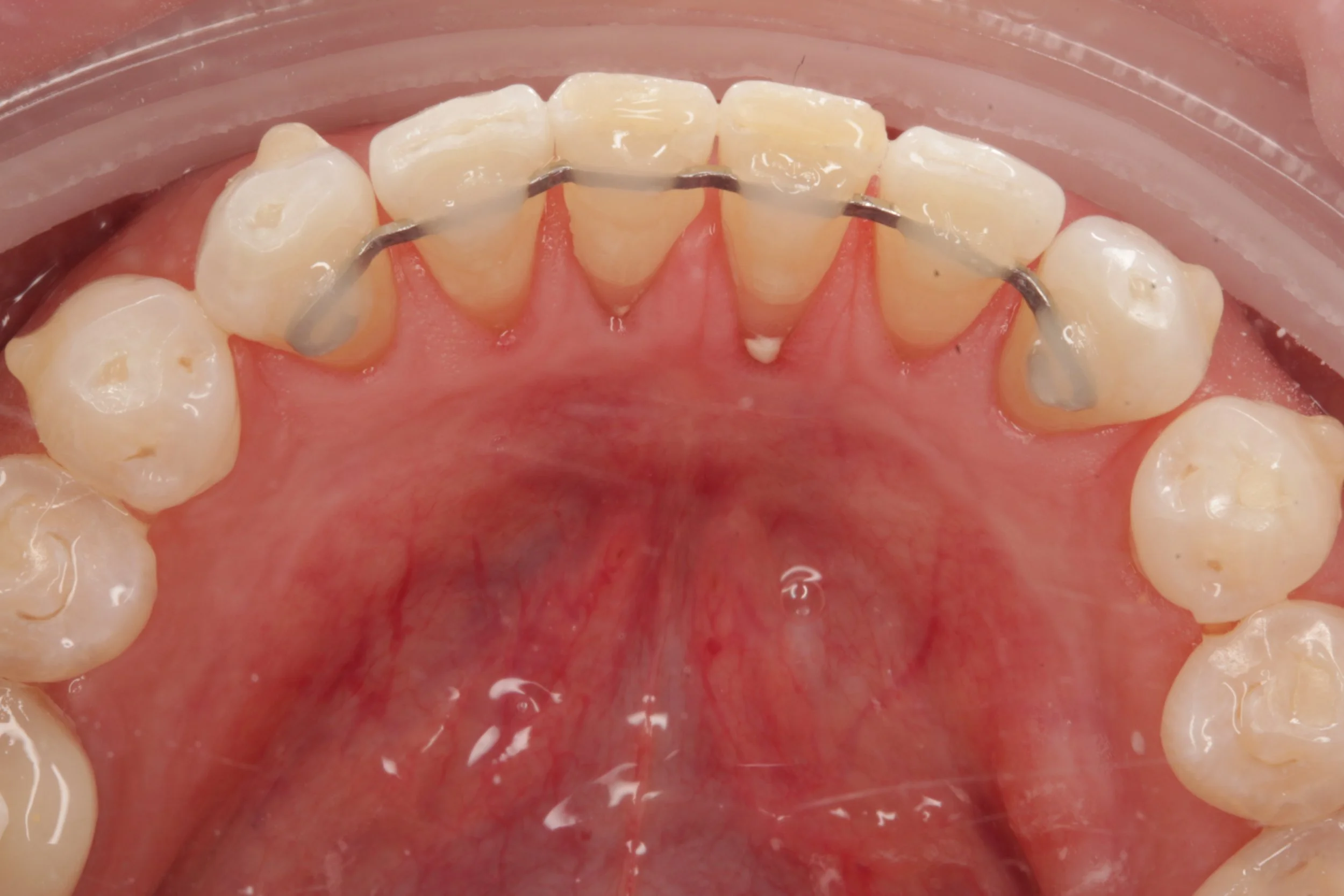 Invisalign Braces - Teeth Straightening, NZ — Clean Teeth Dental