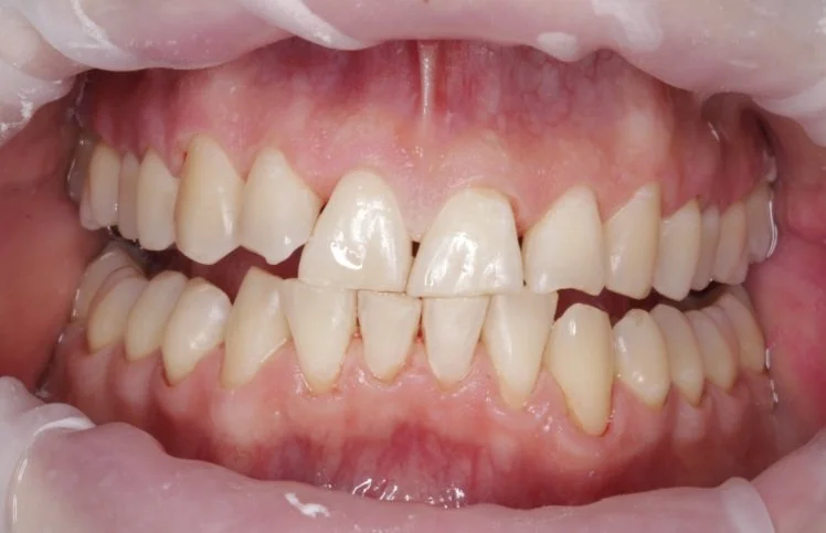 Gingivitis Treatment in Auckland, NZ — Clean Teeth Dental