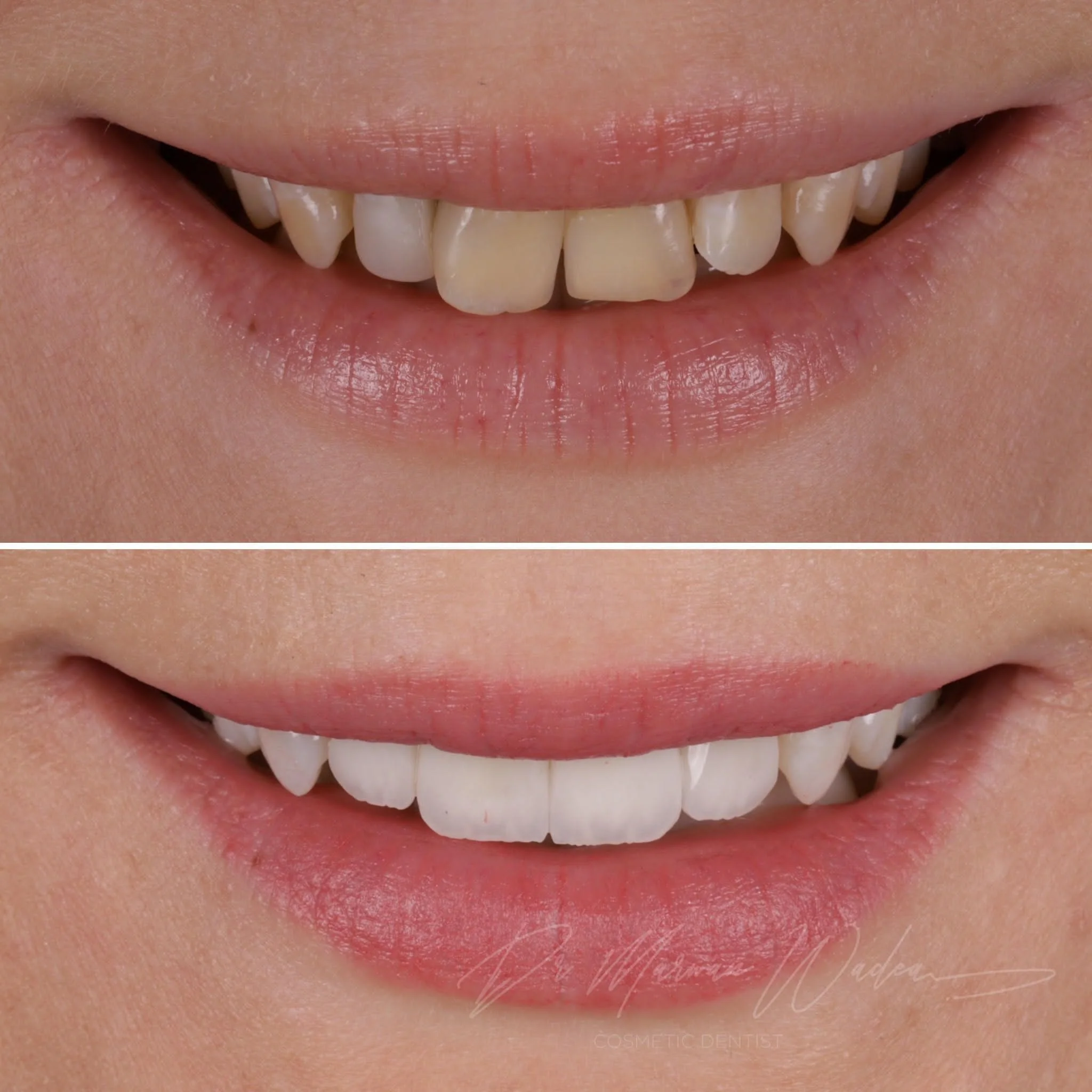 Porcelain Veneers Before & After, NZ — Clean Teeth Dental