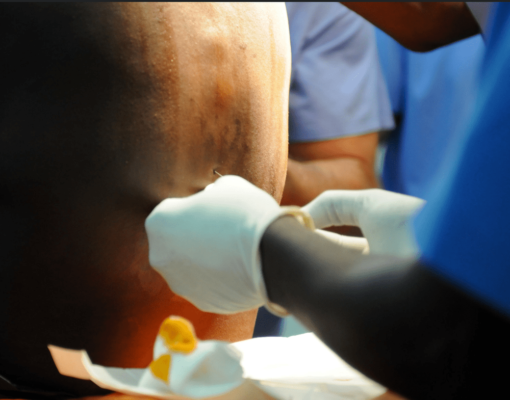 Spinal Anesthesia — Anesthesia Associates, LLP