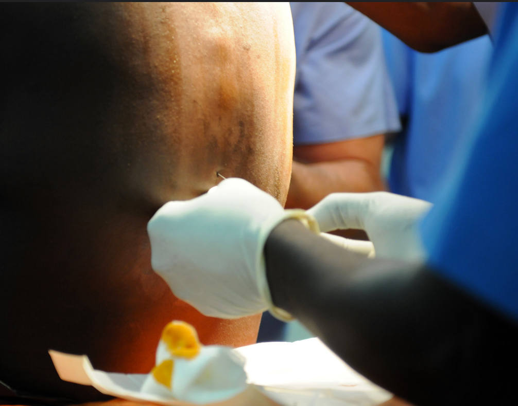 Spinal Anesthesia — Anesthesia Associates, LLP