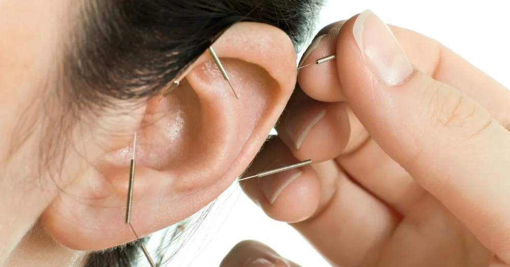 Acupuncture Ear Seeds In Broward County