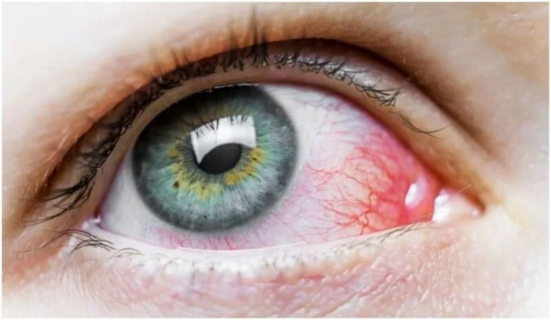 Eye Fungus