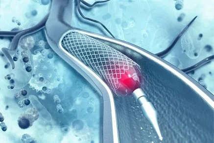Understanding the lifecycle of a stent in the heart — Medipulse: Best ...