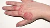 Ten common skin conditions with photos & treatment options — Medipulse ...