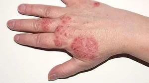 Ten common skin conditions with photos & treatment options — Medipulse ...