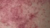 Ten common skin conditions with photos & treatment options — Medipulse ...
