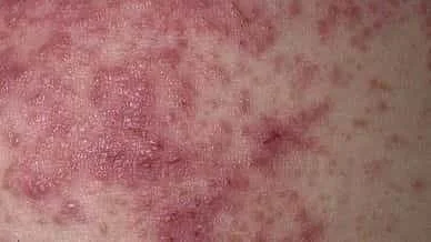 Ten common skin conditions with photos & treatment options — Medipulse ...