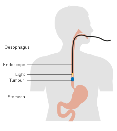 Endoscopy: Role and importance — Medipulse: Best Private Hospital in ...