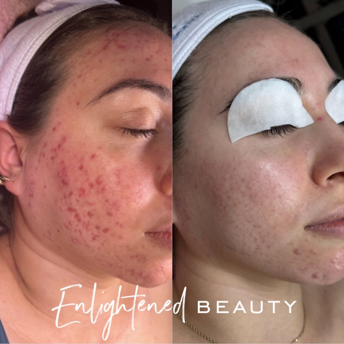 Possible Causes of Acne — Enlightened Beauty by Morgan Elizabeth
