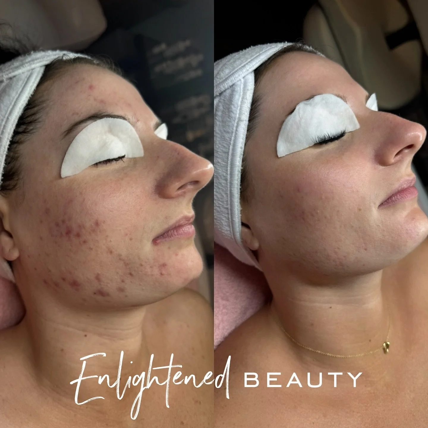 Pigmentation Starter Kit — Enlightened Beauty by Morgan Elizabeth