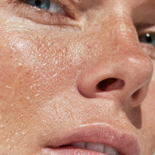 Sebaceous Filaments, Milia, Closed Comedones: What’s Actually on Your ...
