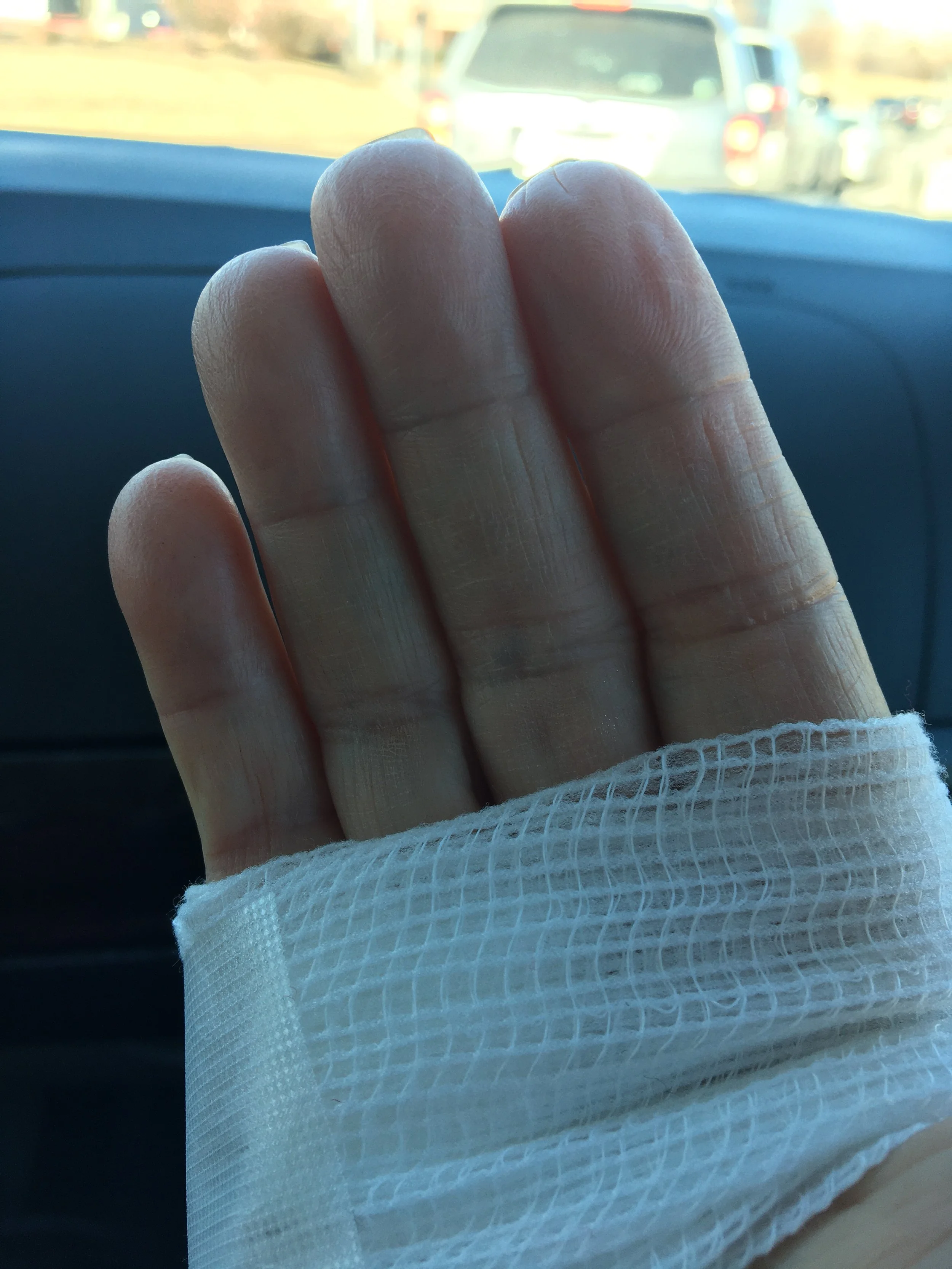Trigger Finger or Dupuytren's Contracture — Runaway and Retire