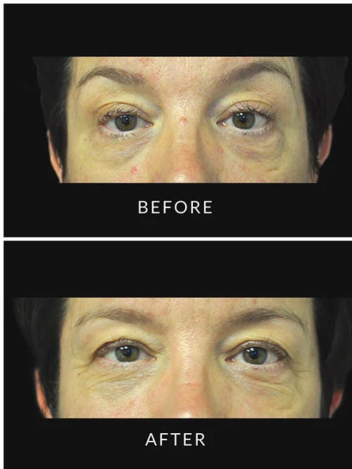Body Contouring at Aesthetic and Wellness Solutions in Plano TX ...