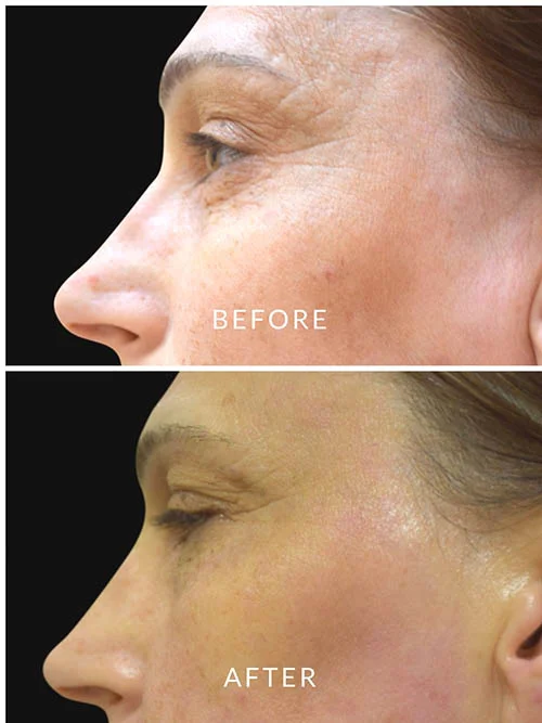 Body Contouring at Aesthetic and Wellness Solutions in Plano TX ...