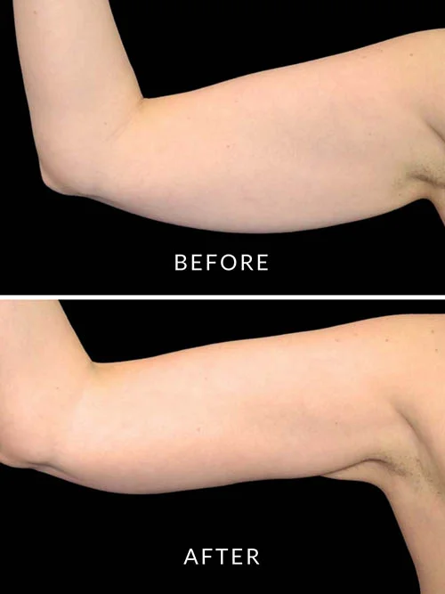 Body Contouring at Aesthetic and Wellness Solutions in Plano TX ...