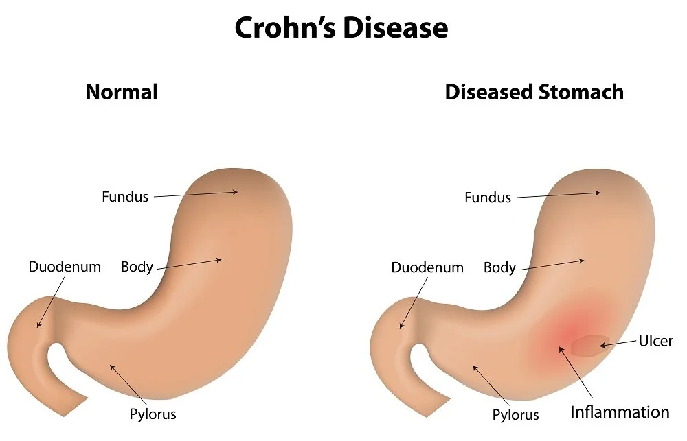Causes Of Postprandial Pain You Should Know causes-of-postprandial-pain-you-should-know
