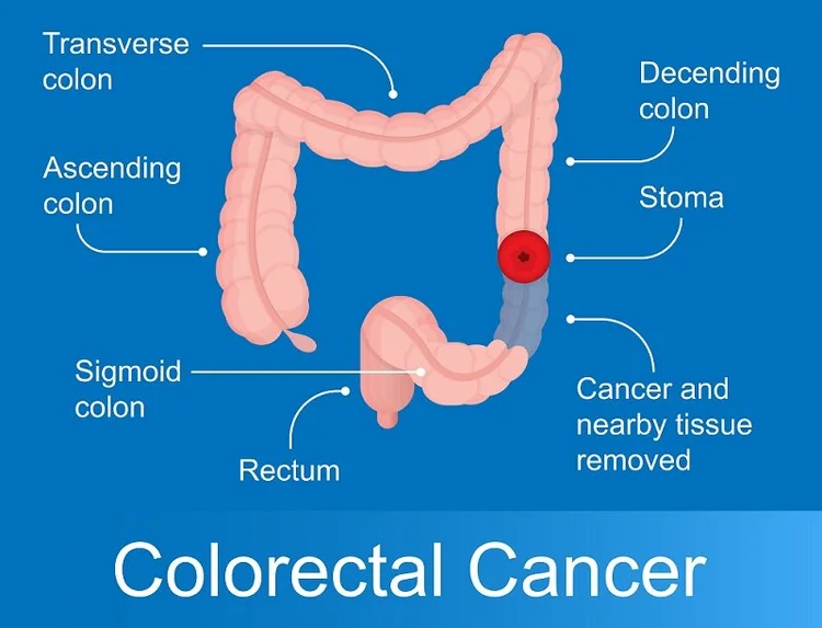 Colon