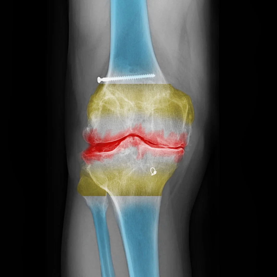 Kniearthrose | Kniegelenksarthrose | Dr. med. Matthias Schmied (Zürich)