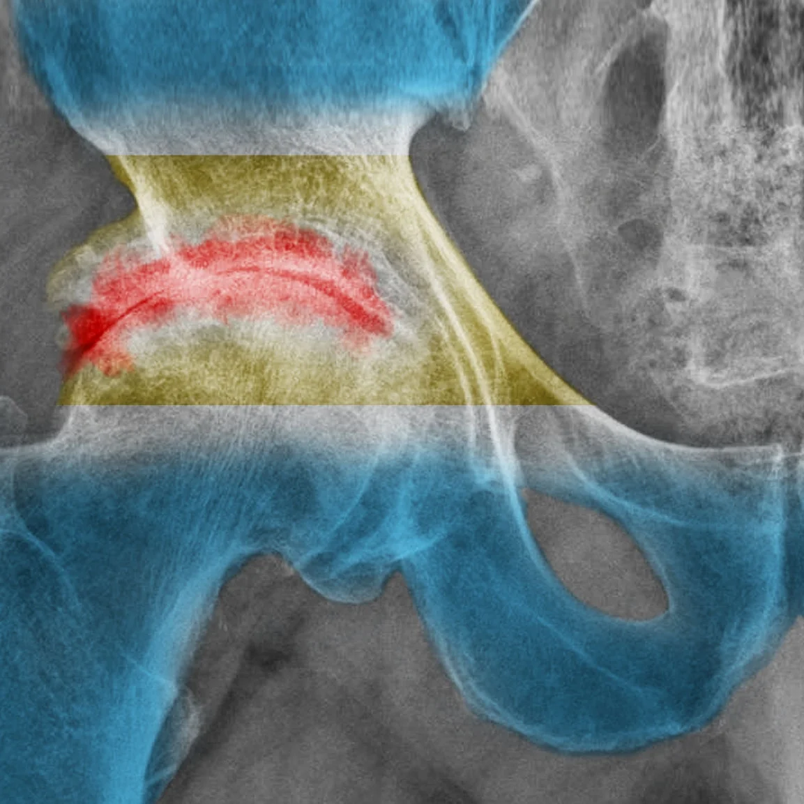Hüftgelenksarthrose | Coxarthrose | Dr. med. Matthias Schmied (Zürich)