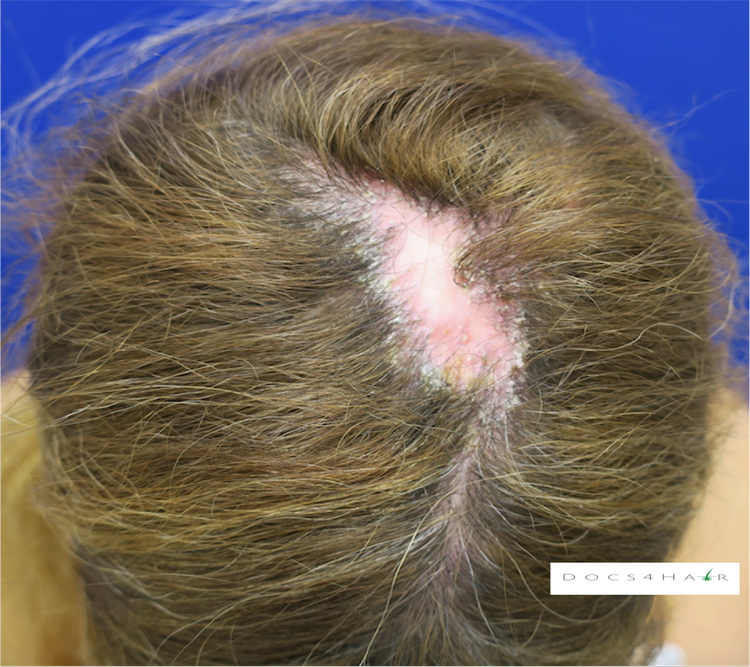 Lichen Planus Scalp Treatment