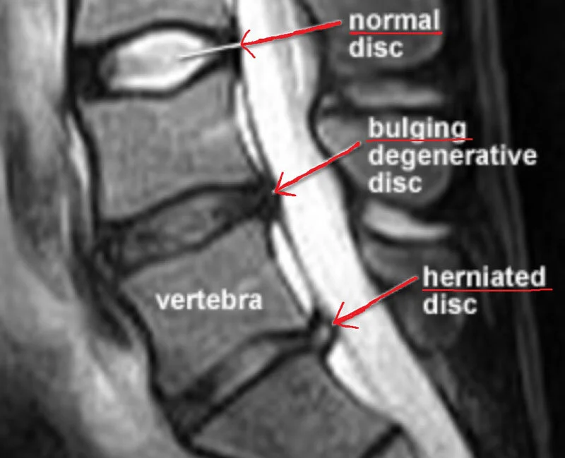Disc Bulge, Herniation, Prolapse, Tear: What is the Difference ? — The ...