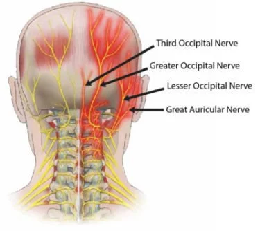 auricular and occipital neuralgia — The Body Works Clinic