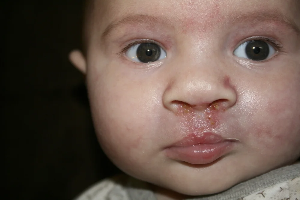 What is a Bilateral Cleft Lip & Palate? — Joyful Wild