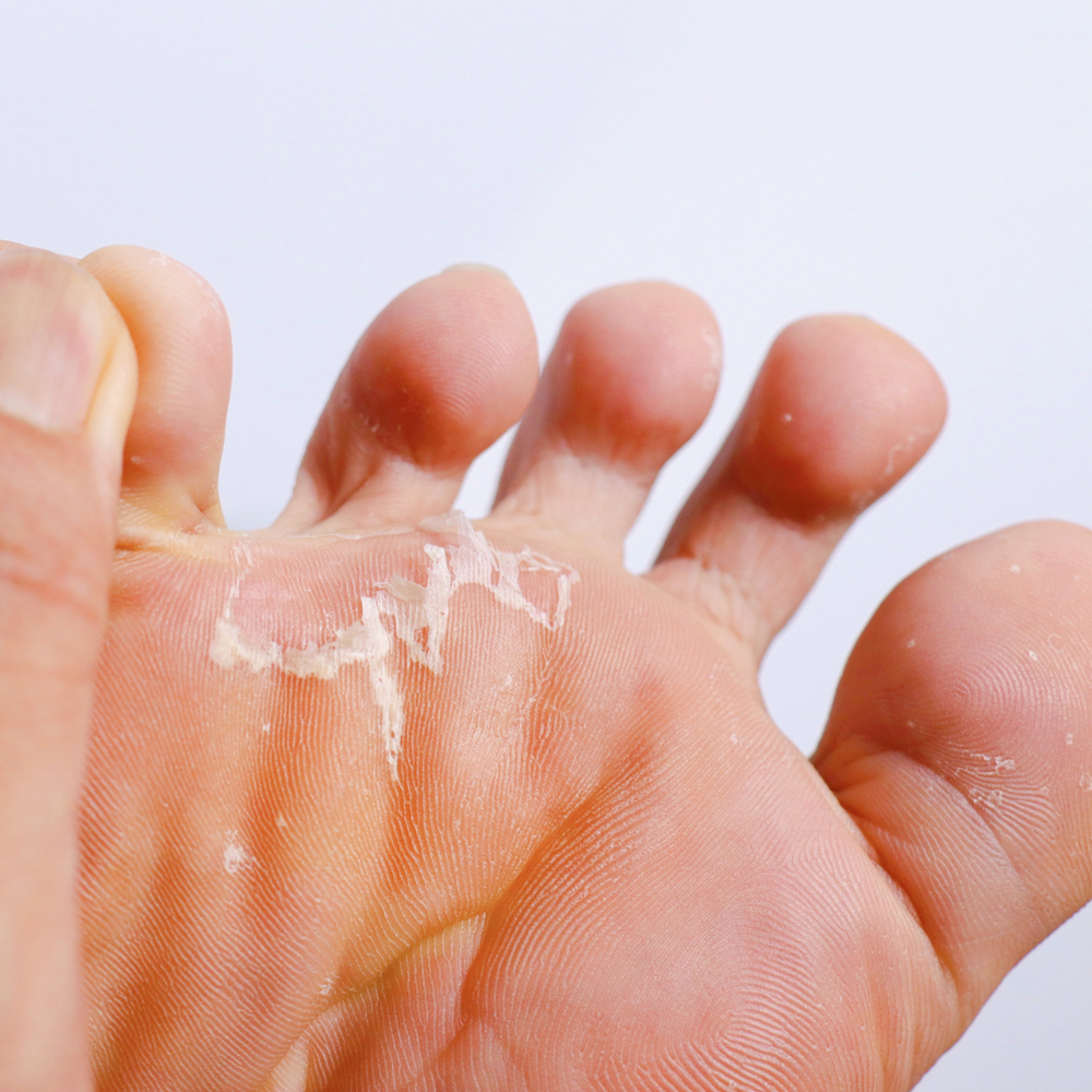 Recognizing Fungal Infections on Your Feet and Toes — Goldsmith Podiatry
