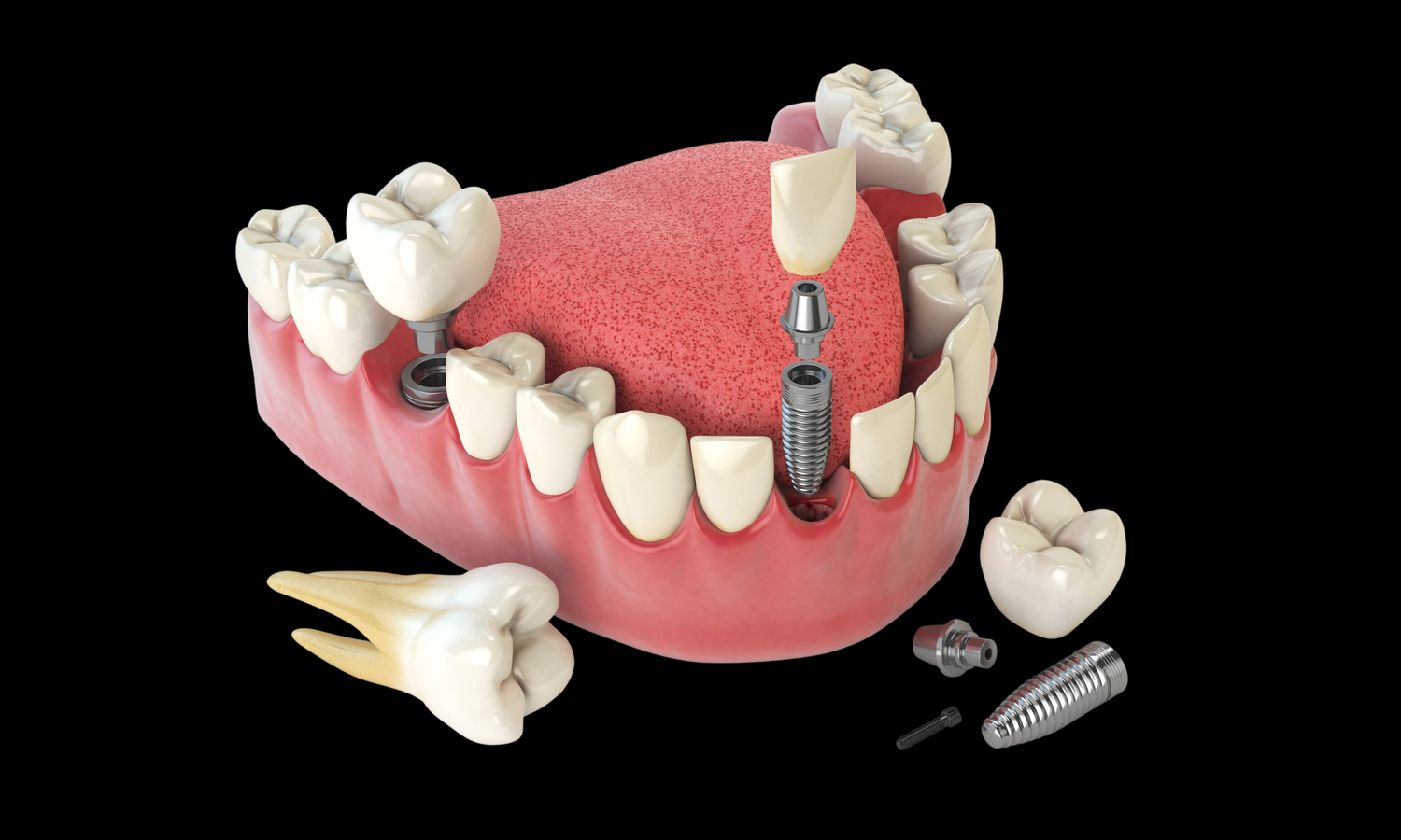 Digital Dental Laboratory DFW | Dental Laboratory Fort Worth