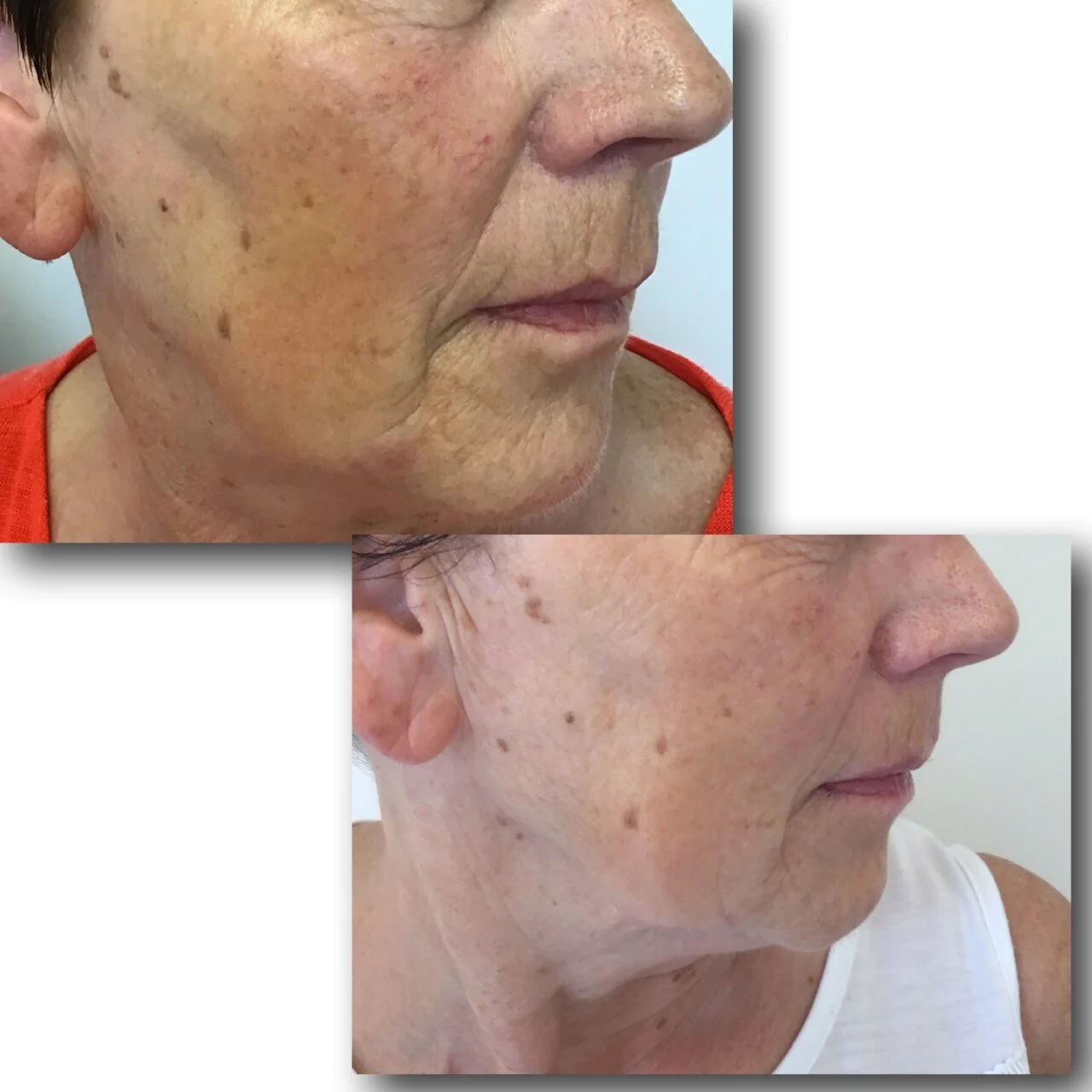 Skin Peels — Primrose Beauty, Laser & Aesthetic Clinic, Limerick