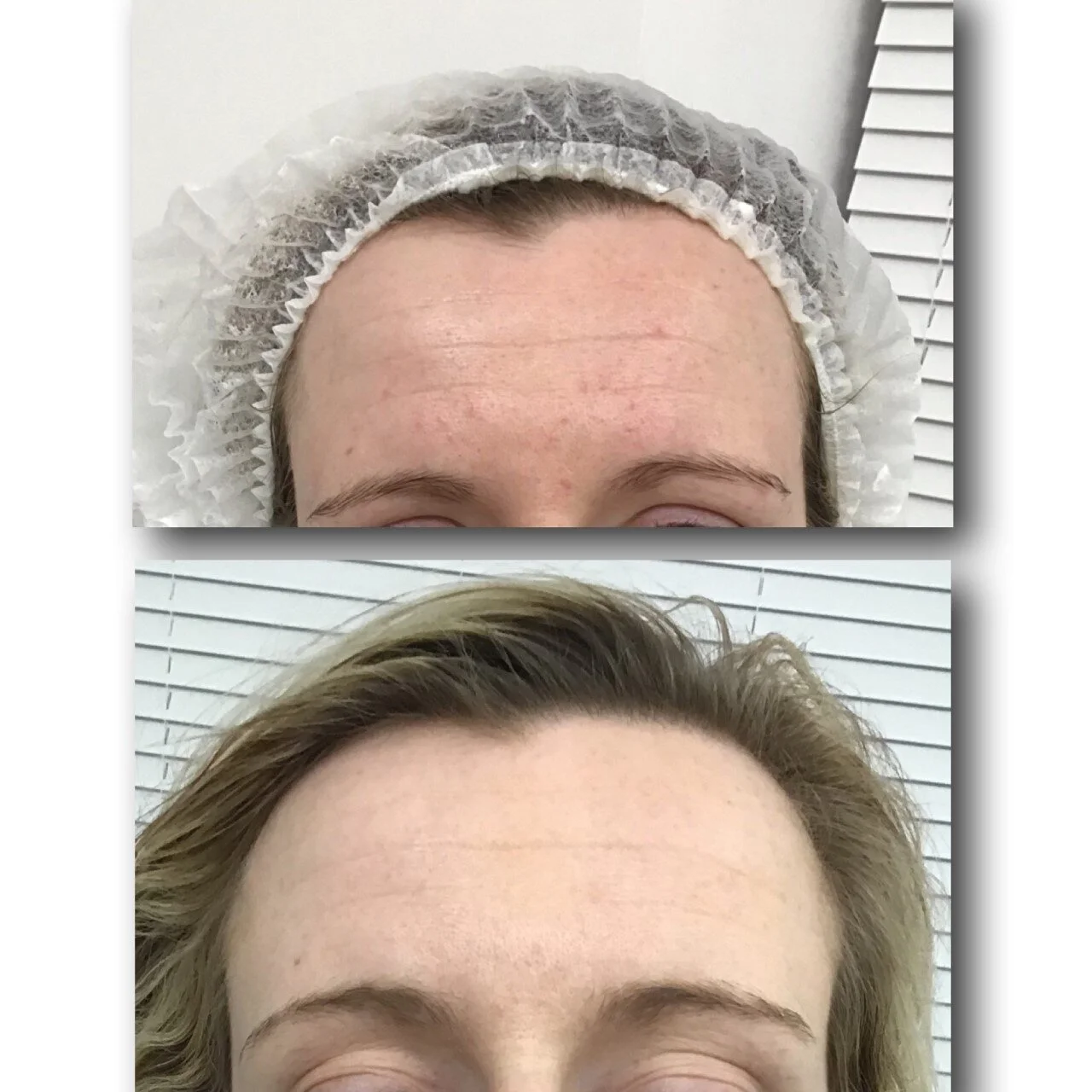 Microneedling — Primrose Beauty, Laser & Aesthetic Clinic, Limerick