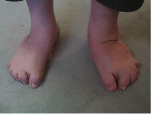 Club Foot Disorders — Davis Shoe Therapeutics