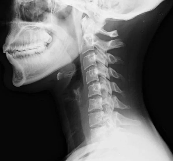 TMJ dysfunction — Lake Washington Physical Therapy