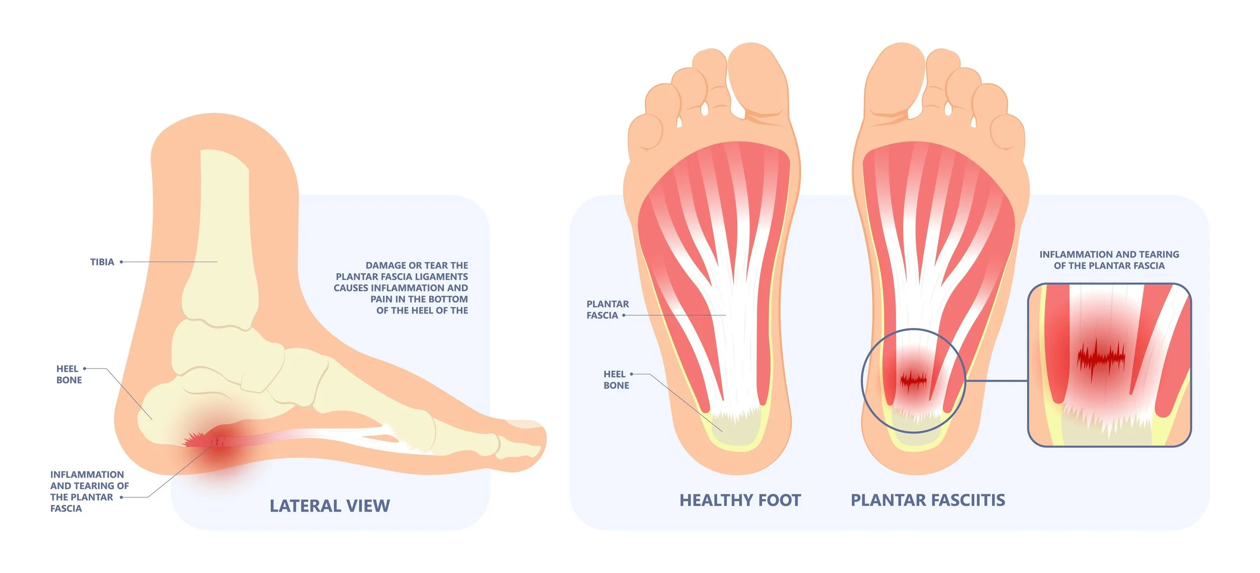 Plantar Fasciitis — Lake Washington Physical Therapy