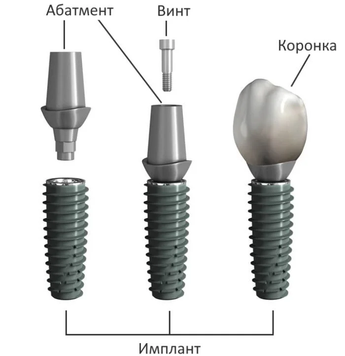 Рейтинг имплантов для зубов - отзывы и сравнение