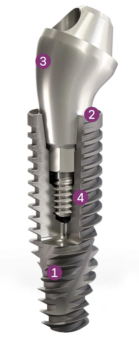 Зубные импланты NEODENT — отзывы пациентов, результаты и эффективность ...