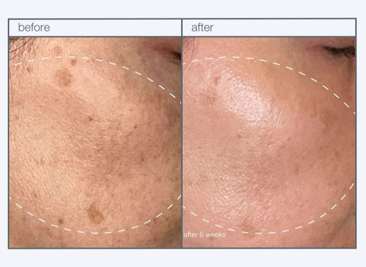 MAXIM — ADVANCED SKIN TREATMENTS-FACIAL PEEL-DERMAPLANING-LUMINFUSION ...