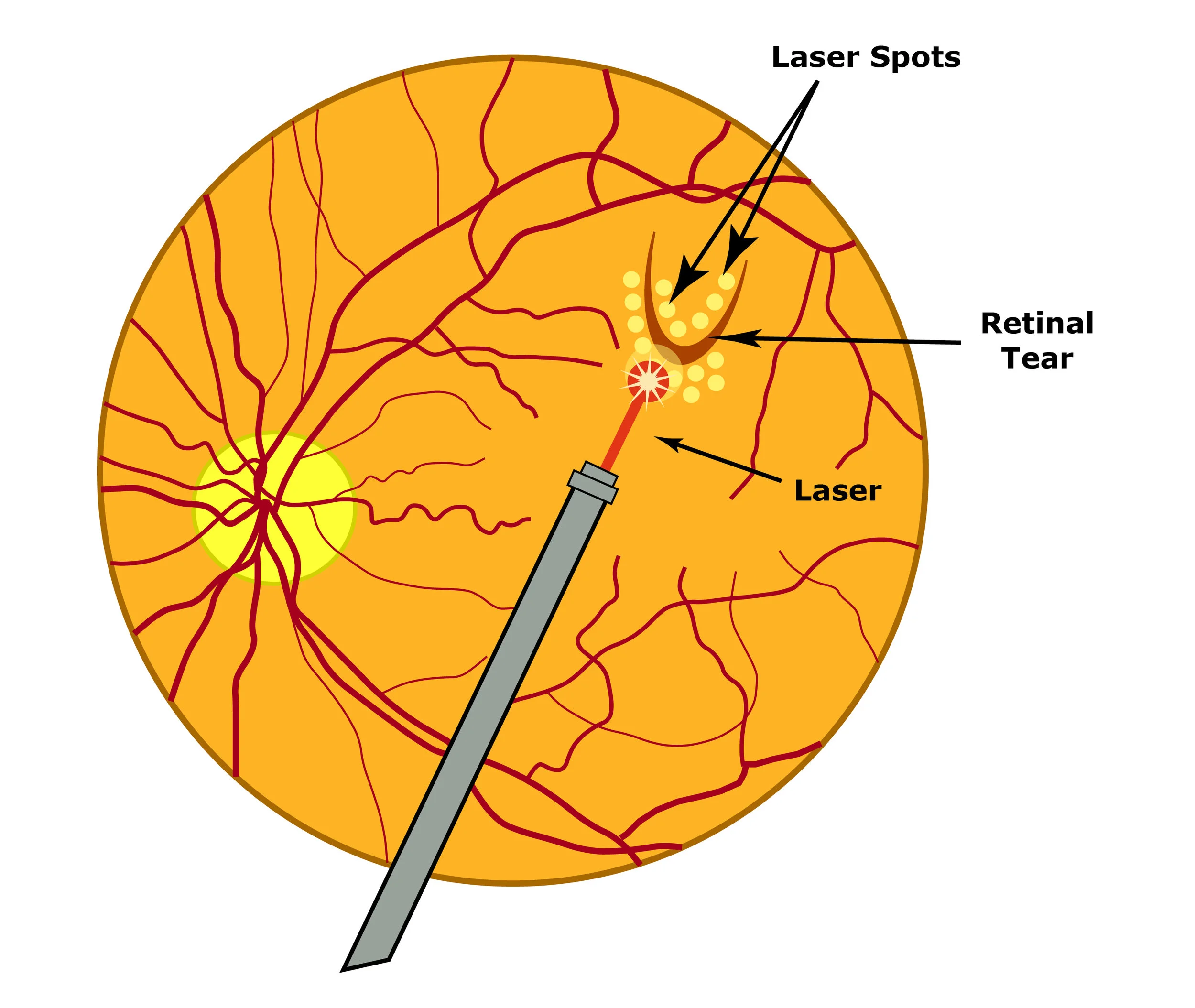 Laser THE RETINA INSTITUTE