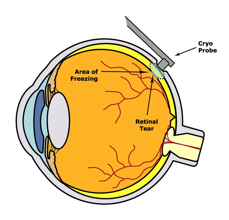 Cryopexy — THE RETINA INSTITUTE