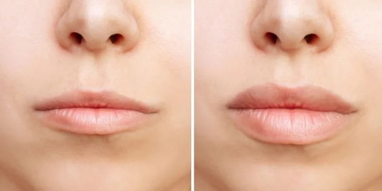 What is a Lip Flip? | BabyFace Med Spa in Scottsdale — Top Rated ...
