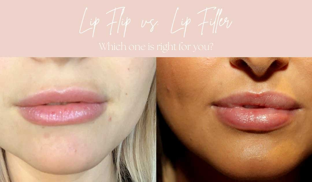 Exploring the Differences Between a Lip Flip vs. Lip Fillers — Top ...