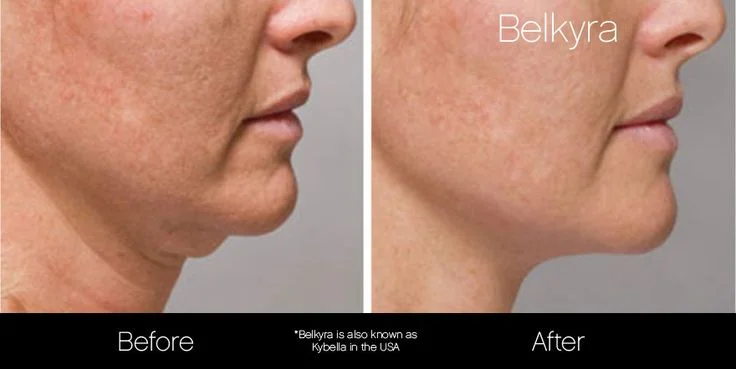 Belkyra™ Double Chin Treatment — Monaco Medical Aesthetics